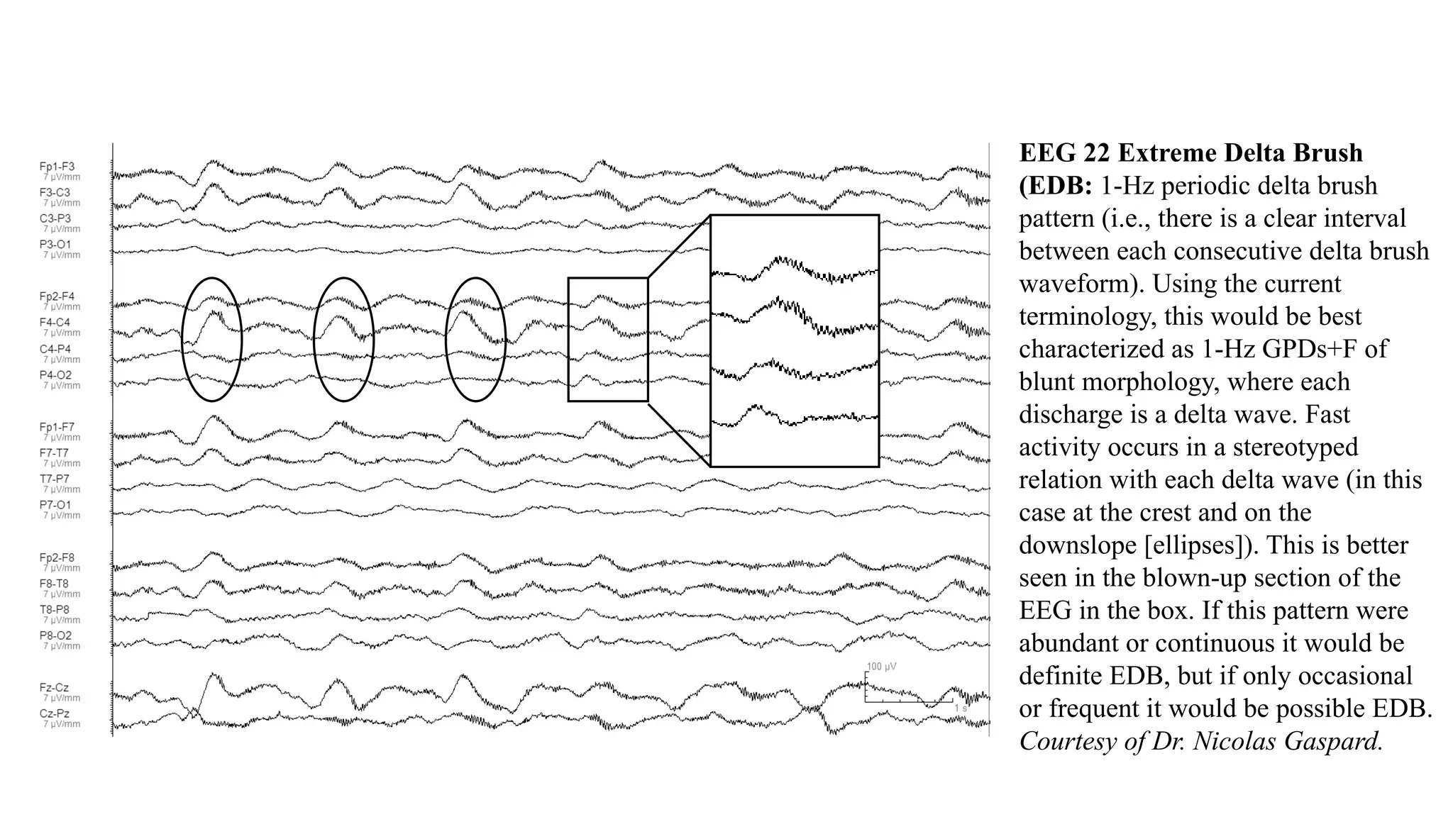ACNS Standardized Critical Care EEG Terminology 2021 | PDF