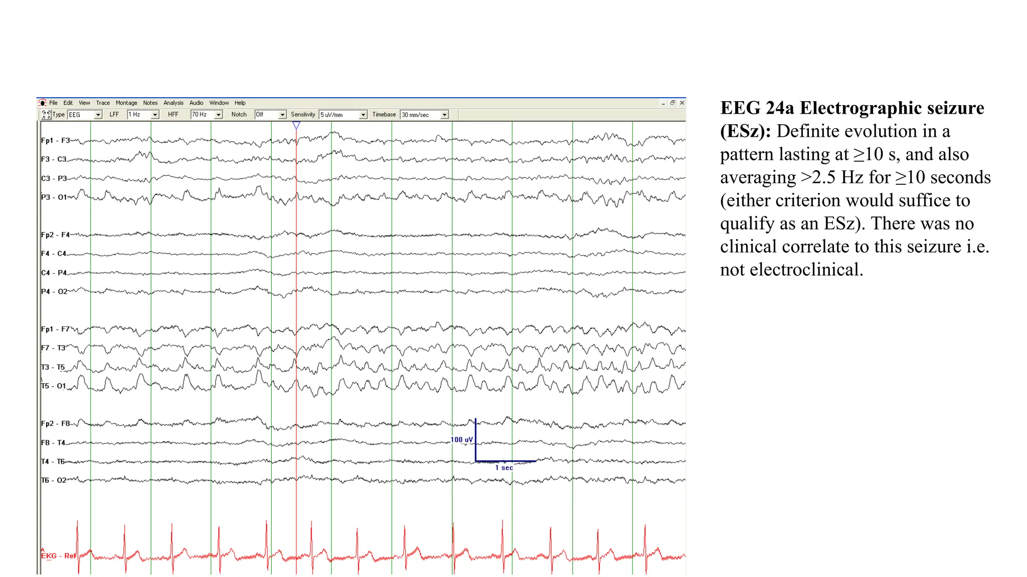 ACNS Standardized Critical Care EEG Terminology 2021 | PDF