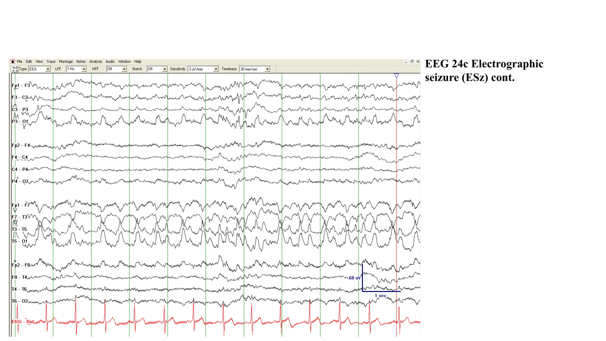 ACNS Standardized Critical Care EEG Terminology 2021 | PDF