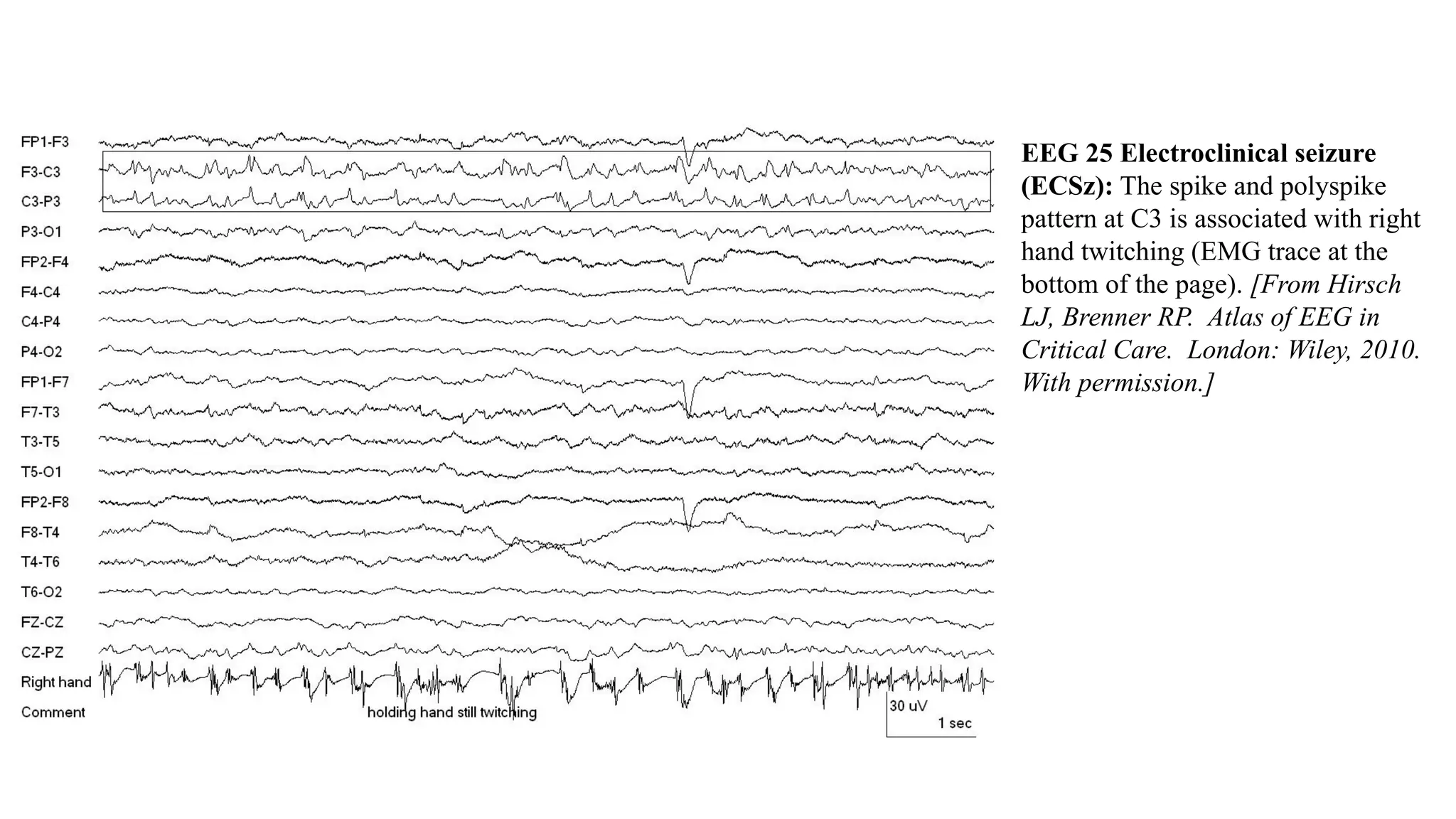 ACNS Standardized Critical Care EEG Terminology 2021 | PDF