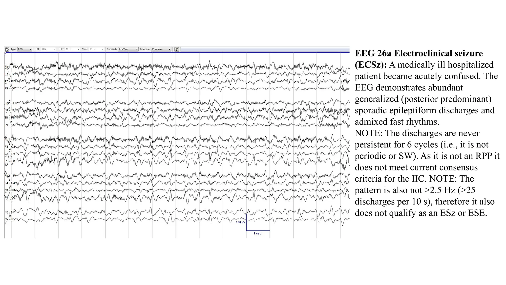 ACNS Standardized Critical Care EEG Terminology 2021 | PDF