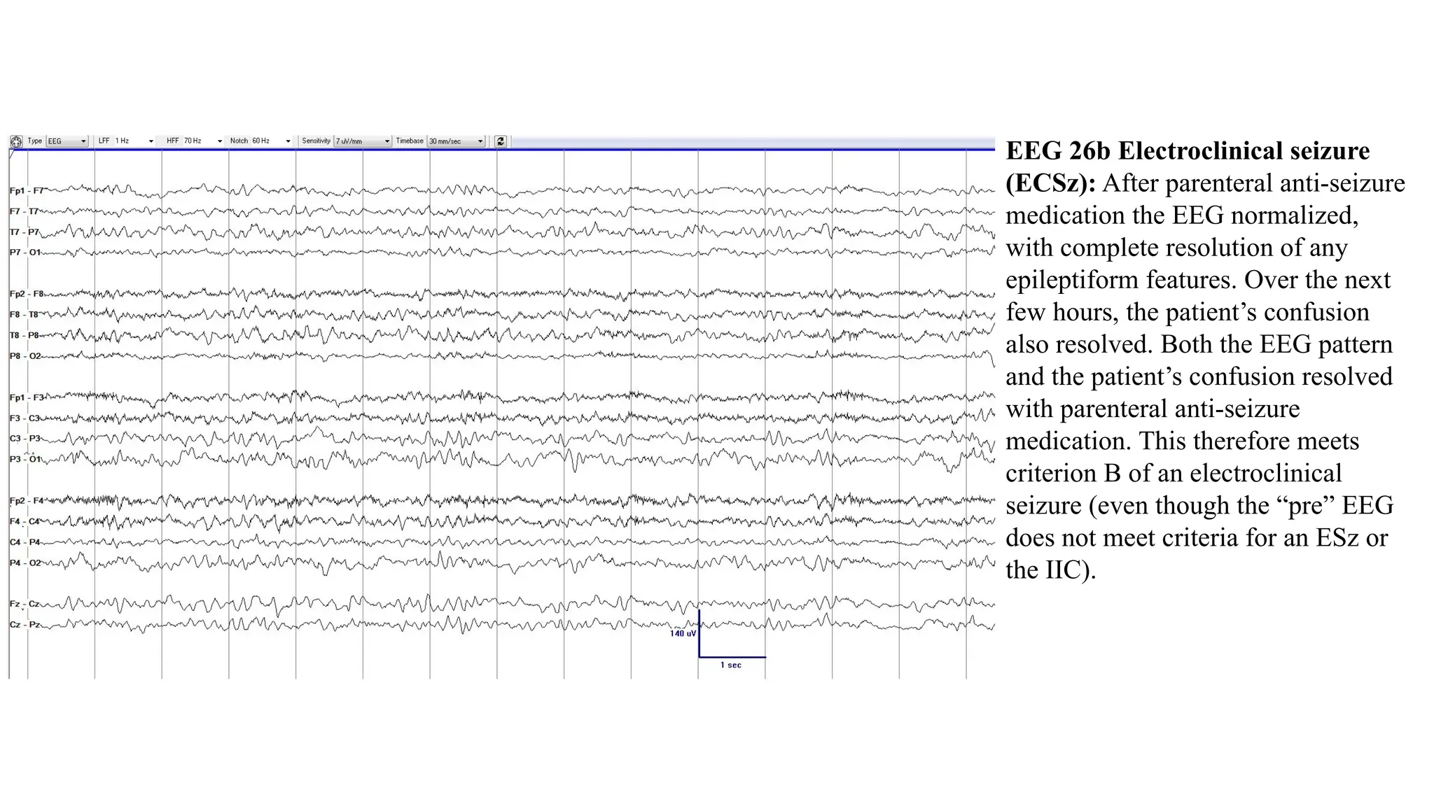 ACNS Standardized Critical Care EEG Terminology 2021 | PDF