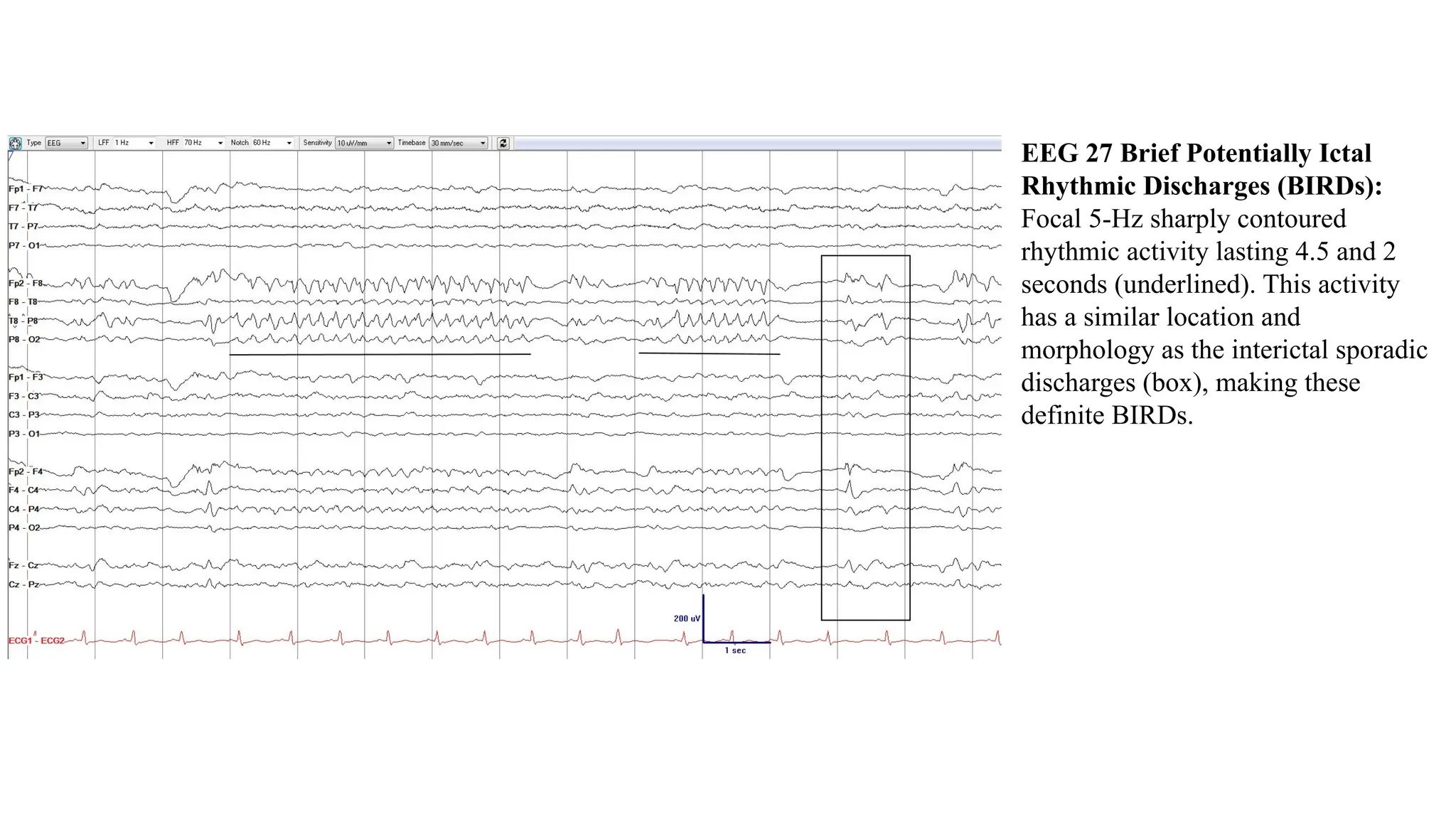 ACNS Standardized Critical Care EEG Terminology 2021 | PDF