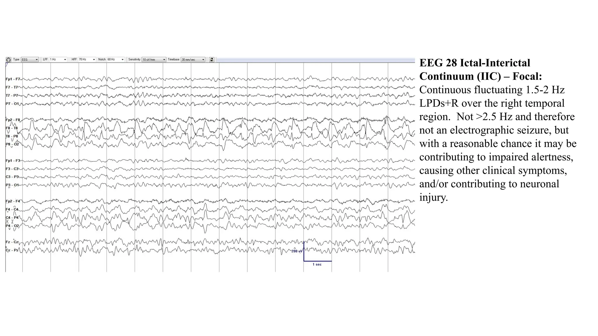 ACNS Standardized Critical Care EEG Terminology 2021 | PDF