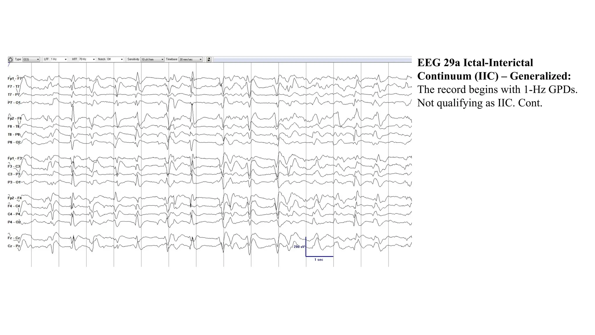 ACNS Standardized Critical Care EEG Terminology 2021 | PDF