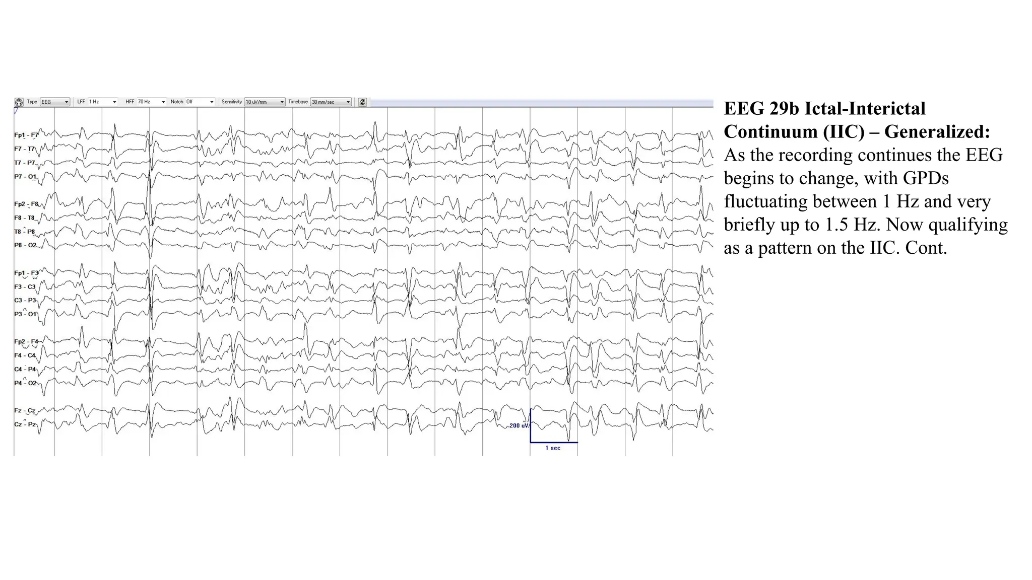 ACNS Standardized Critical Care EEG Terminology 2021 | PDF