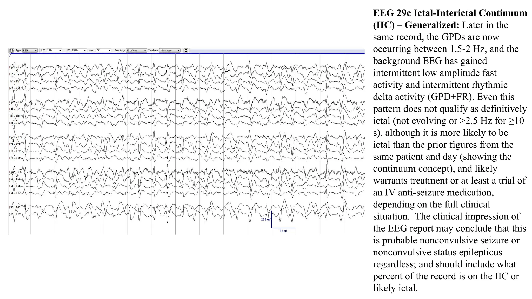 ACNS Standardized Critical Care EEG Terminology 2021 | PDF