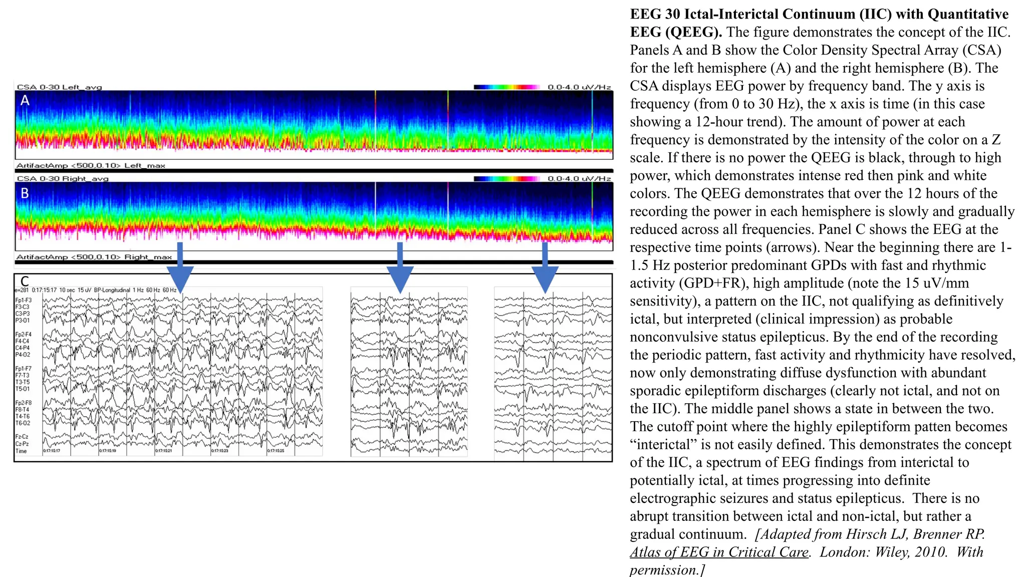 ACNS Standardized Critical Care EEG Terminology 2021 | PDF