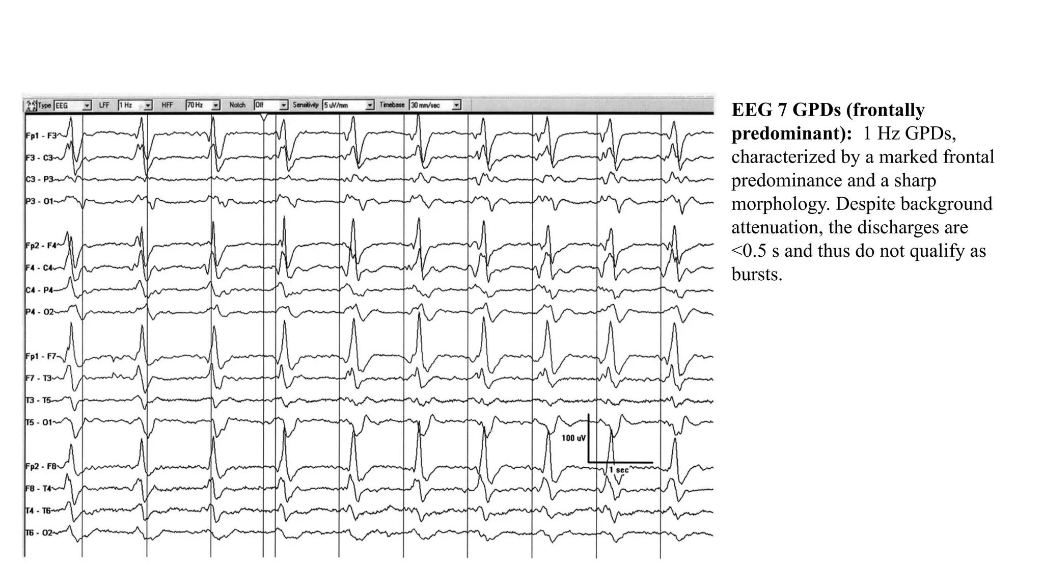 ACNS Standardized Critical Care EEG Terminology 2021 | PDF
