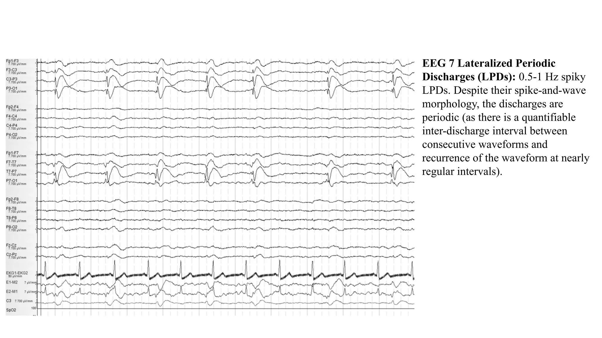 ACNS Standardized Critical Care EEG Terminology 2021 | PDF