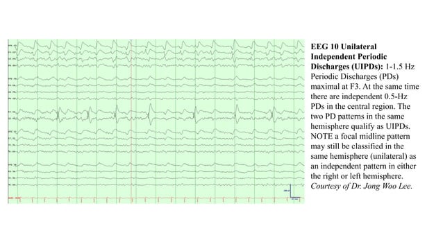 ACNS Standardized Critical Care EEG Terminology 2021 | PDF