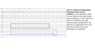 ACNS Standardized Critical Care EEG Terminology 2021 | PDF