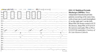 ACNS Standardized Critical Care EEG Terminology 2021 | PDF