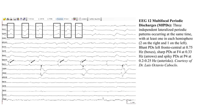 ACNS Standardized Critical Care EEG Terminology 2021 | PDF