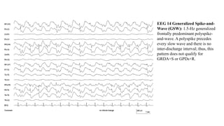 ACNS Standardized Critical Care EEG Terminology 2021 | PDF