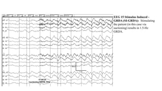 ACNS Standardized Critical Care EEG Terminology 2021 | PDF