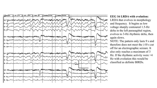 ACNS Standardized Critical Care EEG Terminology 2021 | PDF