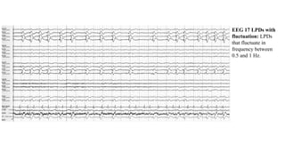 ACNS Standardized Critical Care EEG Terminology 2021 | PDF