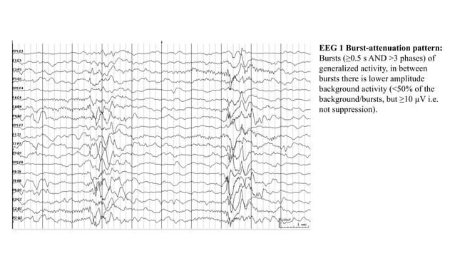 ACNS Standardized Critical Care EEG Terminology 2021 | PDF
