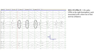 ACNS Standardized Critical Care EEG Terminology 2021 | PDF