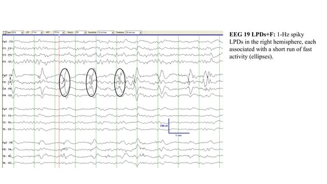 ACNS Standardized Critical Care EEG Terminology 2021 | PDF