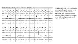 ACNS Standardized Critical Care EEG Terminology 2021 | PDF