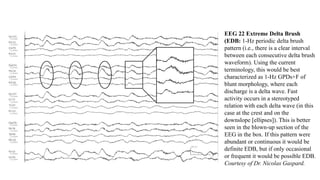 ACNS Standardized Critical Care EEG Terminology 2021 | PDF