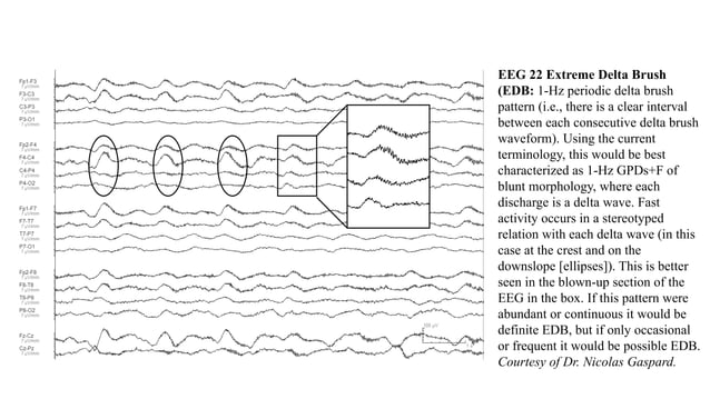 ACNS Standardized Critical Care EEG Terminology 2021 | PDF