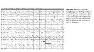 ACNS Standardized Critical Care EEG Terminology 2021 | PDF