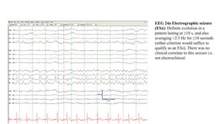ACNS Standardized Critical Care EEG Terminology 2021 | PDF