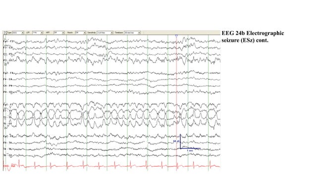 ACNS Standardized Critical Care EEG Terminology 2021 | PDF