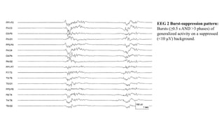 ACNS Standardized Critical Care EEG Terminology 2021 | PDF