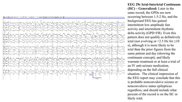 ACNS Standardized Critical Care EEG Terminology 2021 | PDF