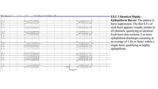 ACNS Standardized Critical Care EEG Terminology 2021 | PDF