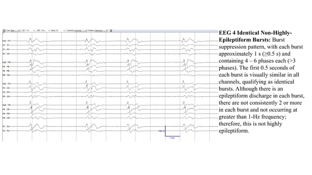 ACNS Standardized Critical Care EEG Terminology 2021 | PDF