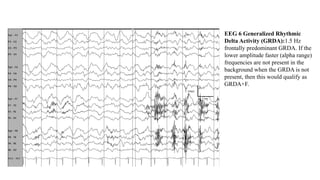 ACNS Standardized Critical Care EEG Terminology 2021 | PDF