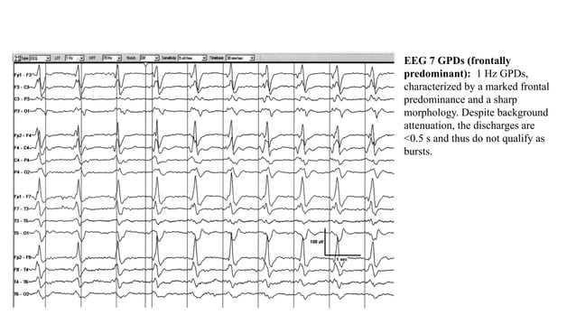 ACNS Standardized Critical Care EEG Terminology 2021 | PDF
