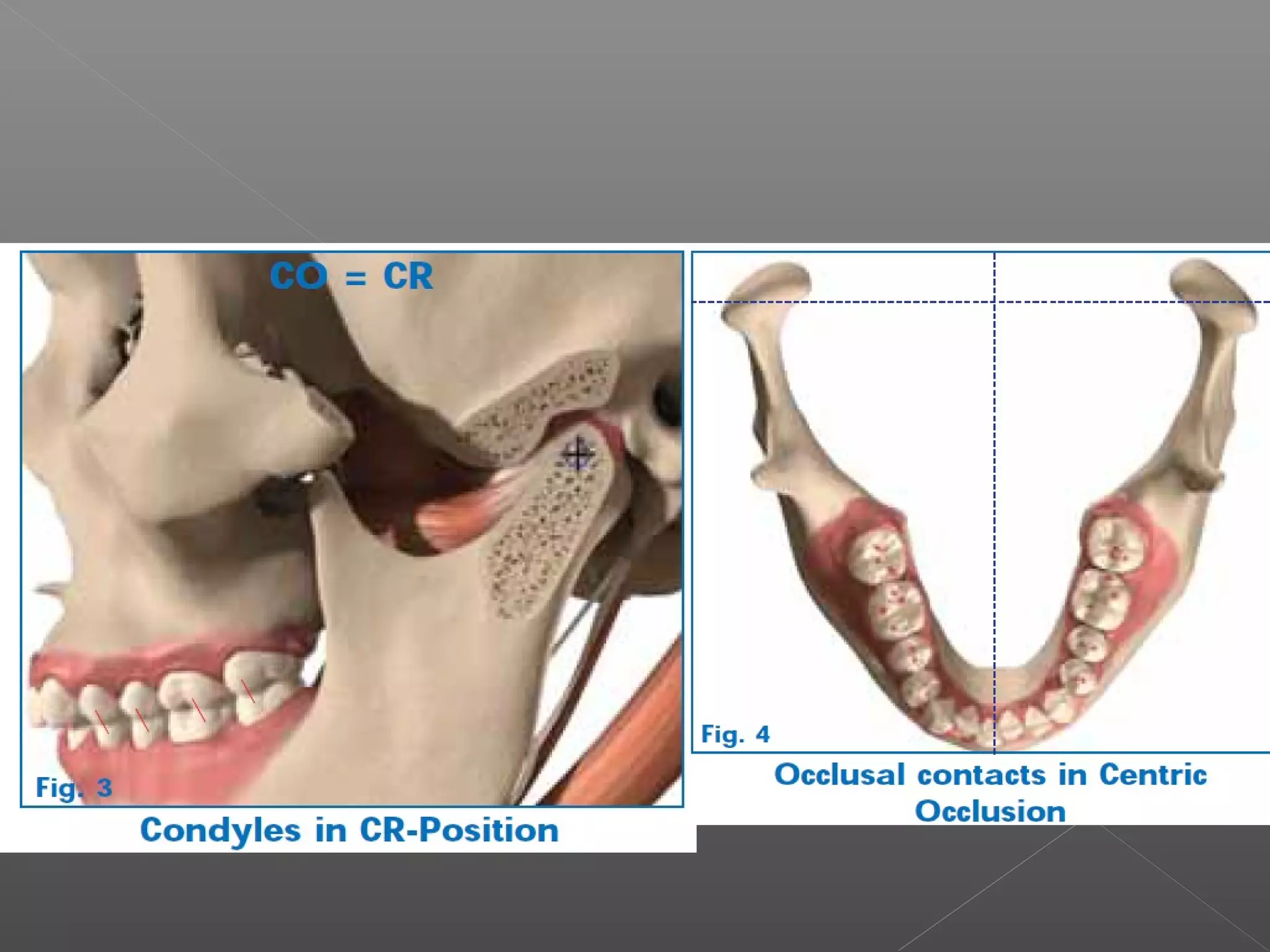 occlusion indicators | PPT