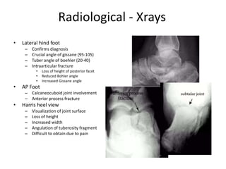 JC on CALCANEUM FRACTURE | PPTX