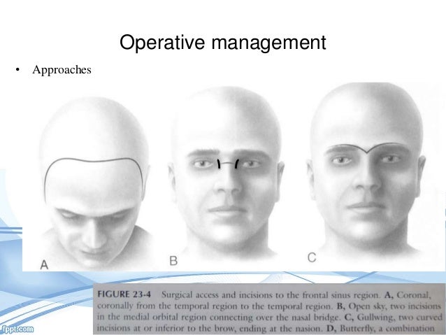 Jc on frontal fracture