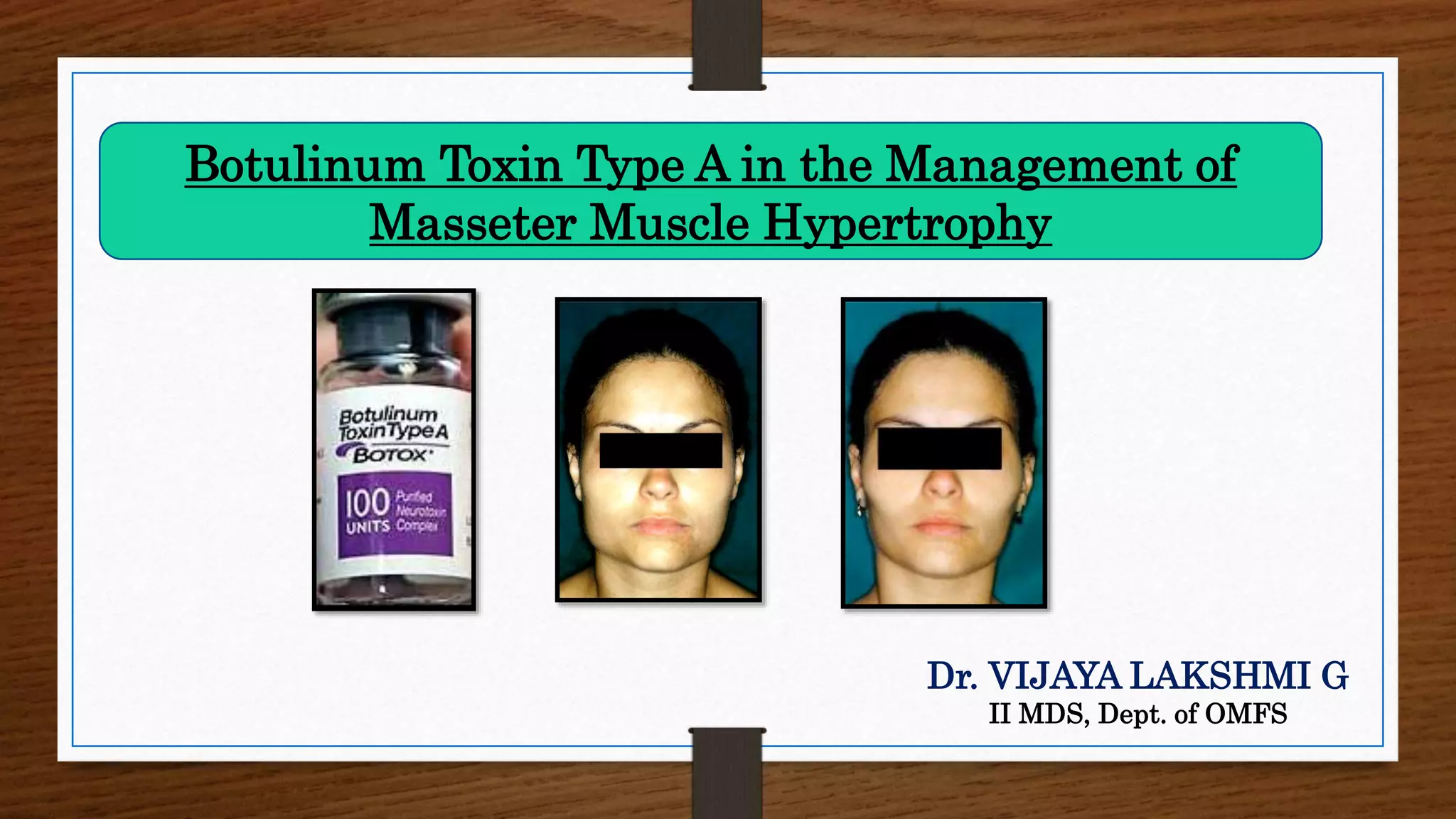 JC on Intramuscular injection of botox for massetric hypertrophy | PPTX