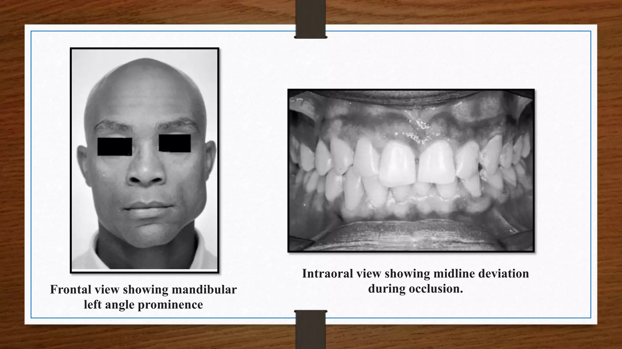 JC on Intramuscular injection of botox for massetric hypertrophy | PPTX