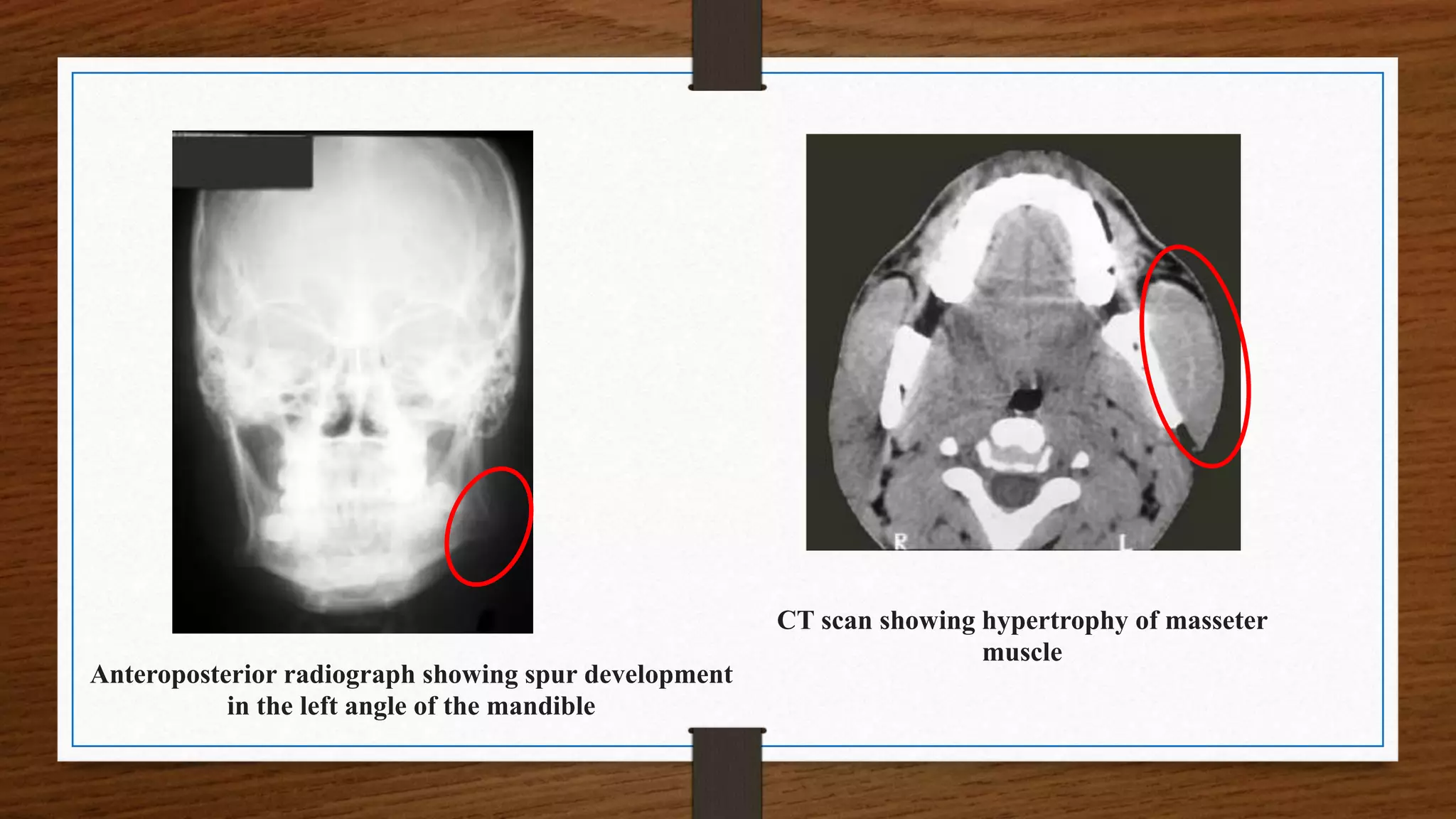 JC on Intramuscular injection of botox for massetric hypertrophy | PPTX