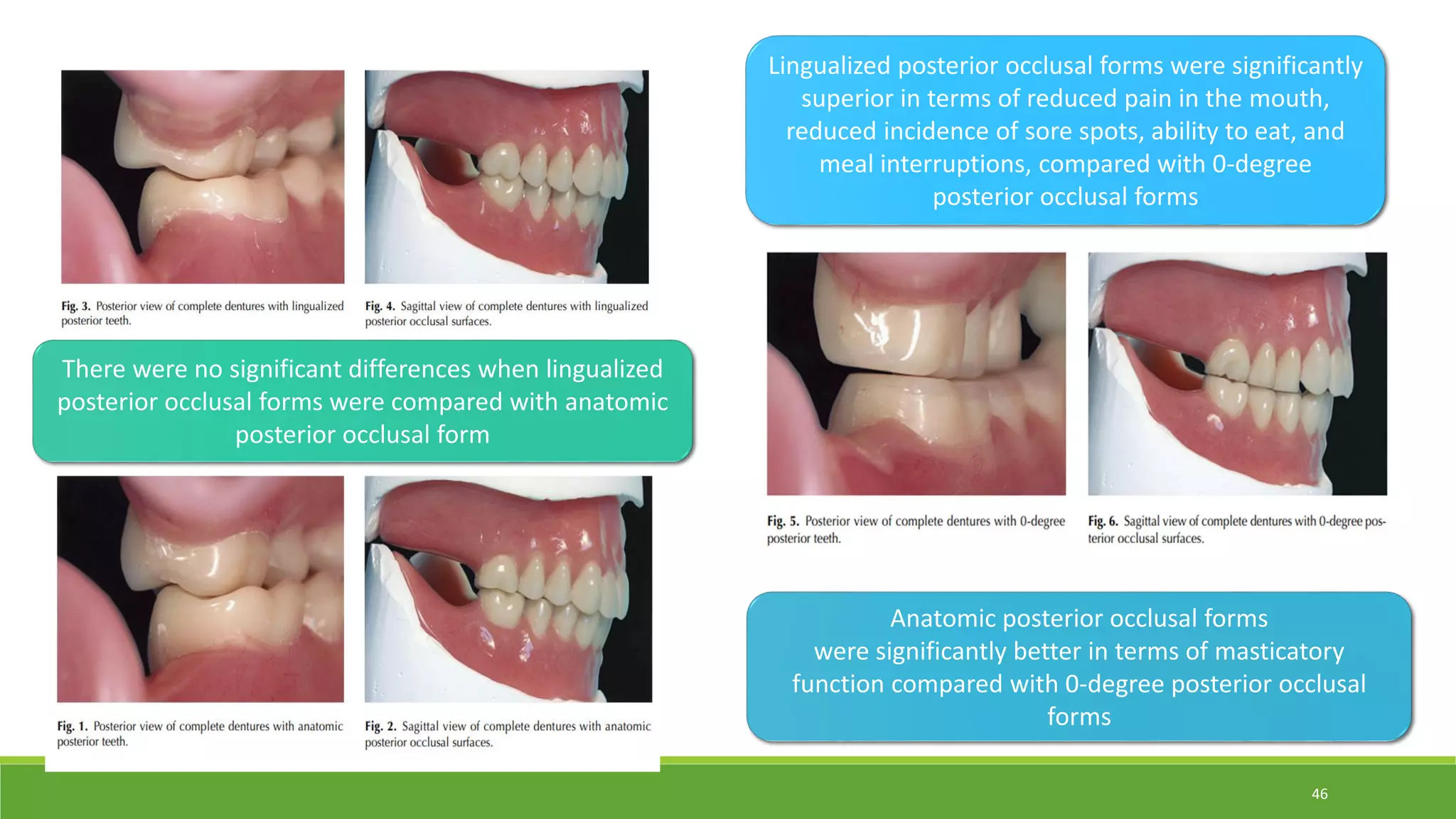 JOURNAL CLUB PRESENTATION on lingualised occlusion | PDF