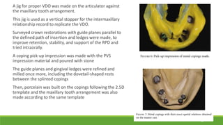 JOURNAL CLUB PRESENTATION on lingualised occlusion | PDF