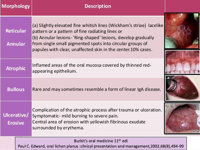 Oral Lichen Planus