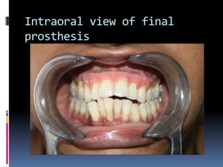 Jc on removable gingival prosthesis | PPT