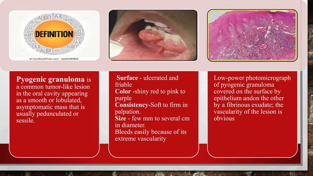 Jc peipheral exophytic growth ppt | PPTX