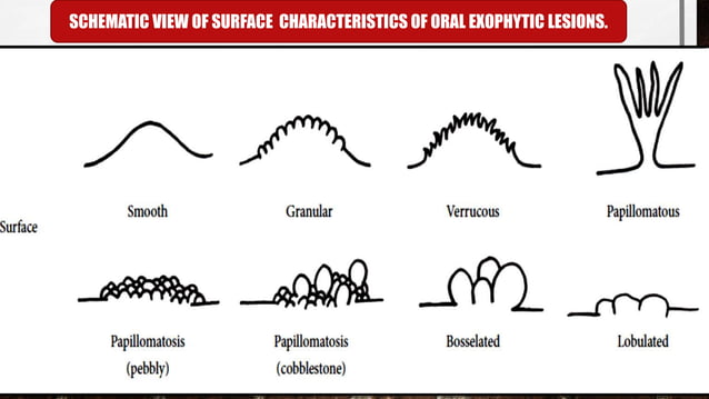 Jc peipheral exophytic growth ppt | PPTX