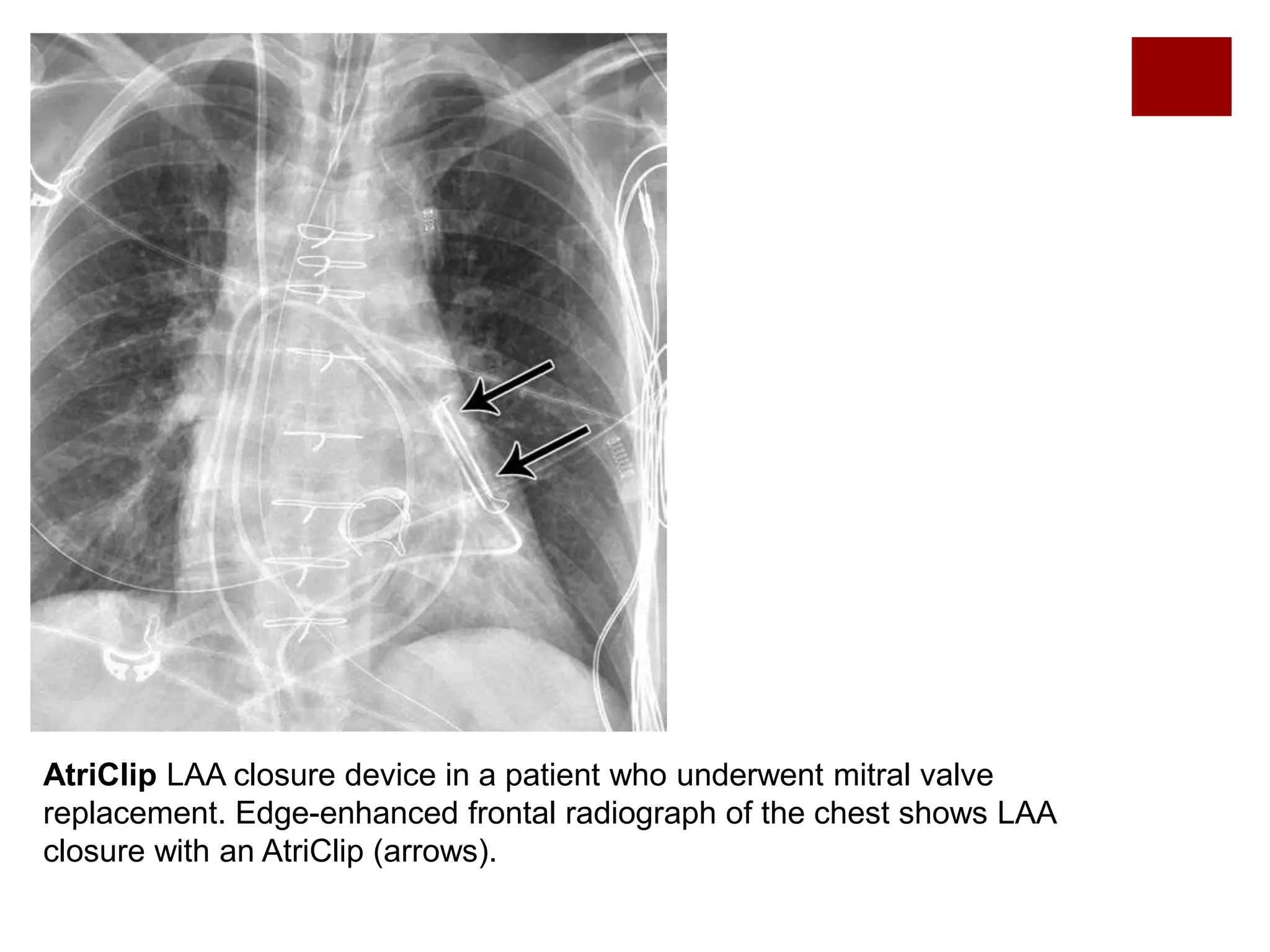 Radiographic Review of Current Therapeutic and Monitoring Devices in ...